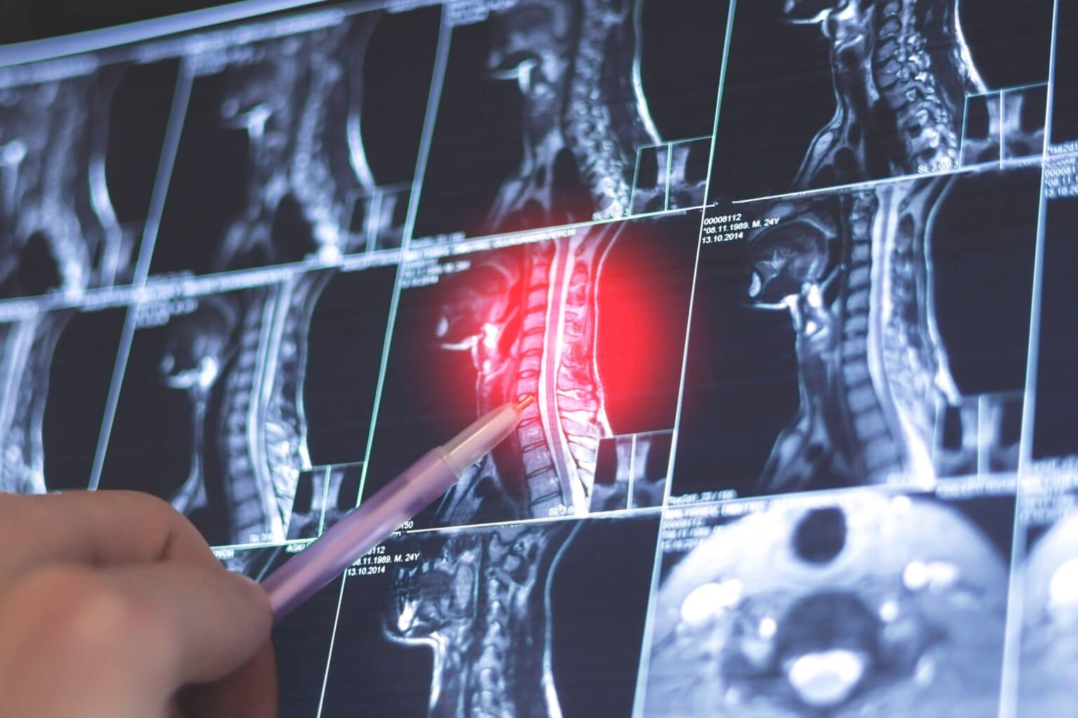 Cervical Radiculopathy Portland OR - Nerve Damage Prevention Portland